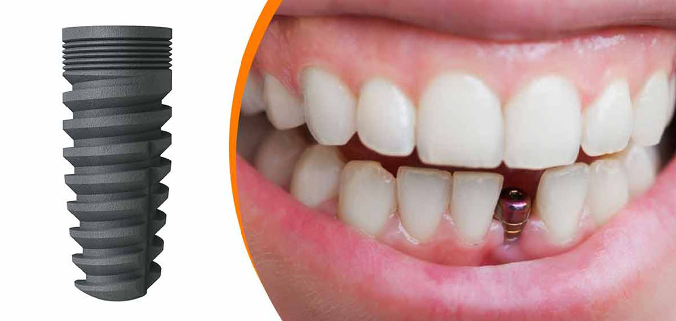 Dental Implant Surgery | post by digistreetmedia