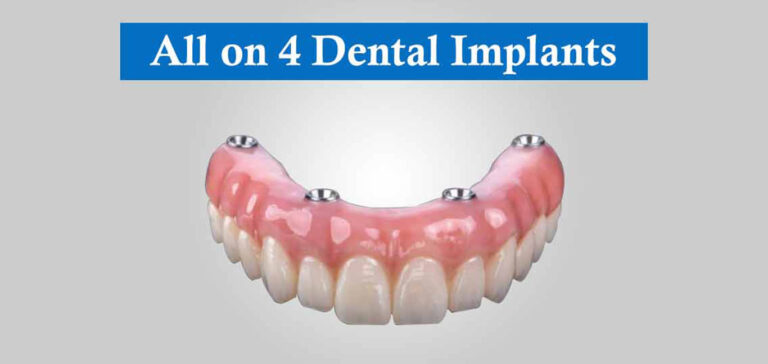 What are All-on-4 Dental Implants in Implant Dentistry? | i-Fix ...